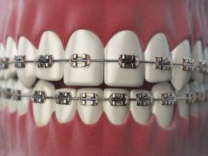 The Cost of Braces in 2025: What You Really Need to Know - Dentovex ...